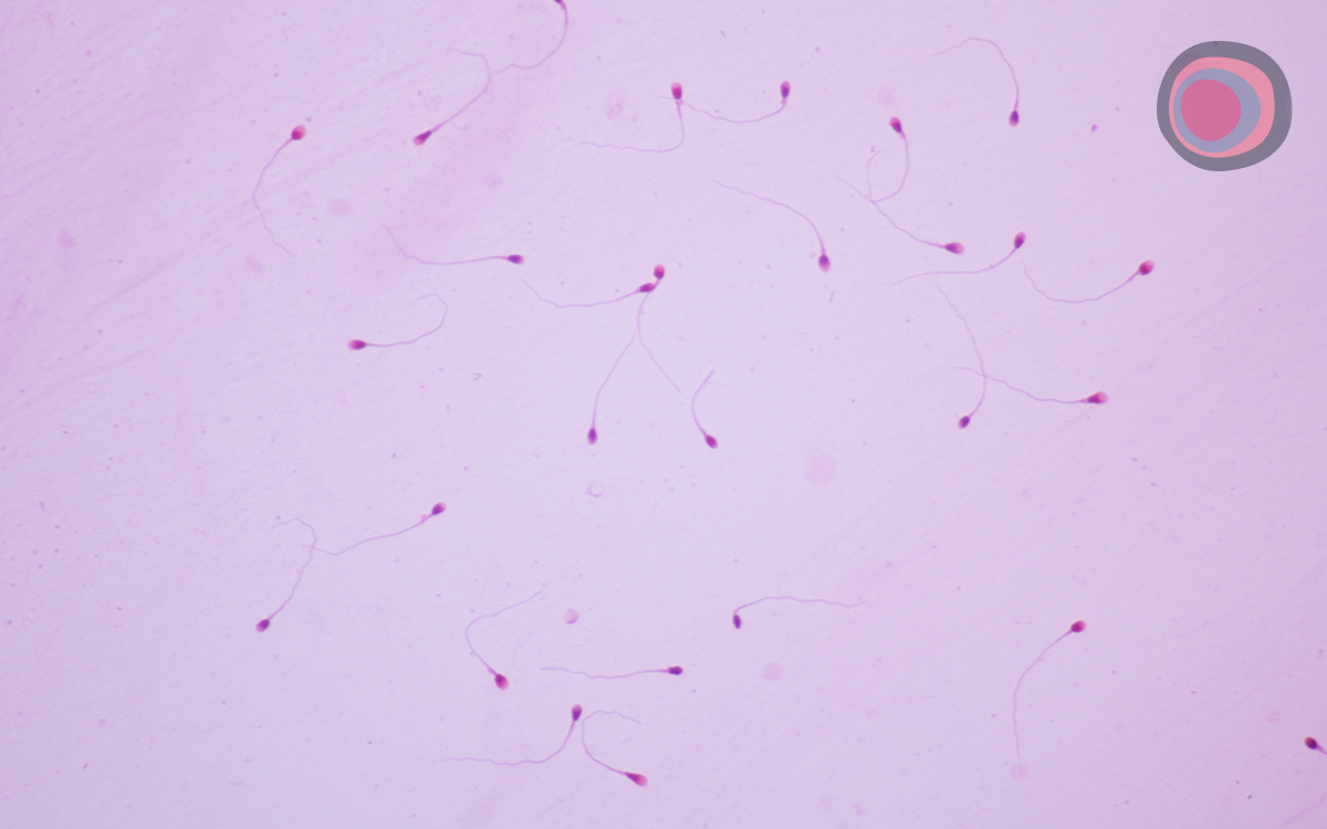 » Espermograma: indicações
