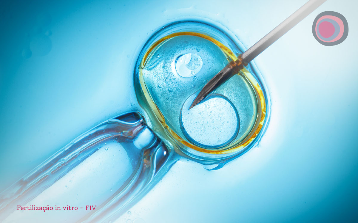 » Mioma subseroso: o que é e qual a relação com a infertilidade?