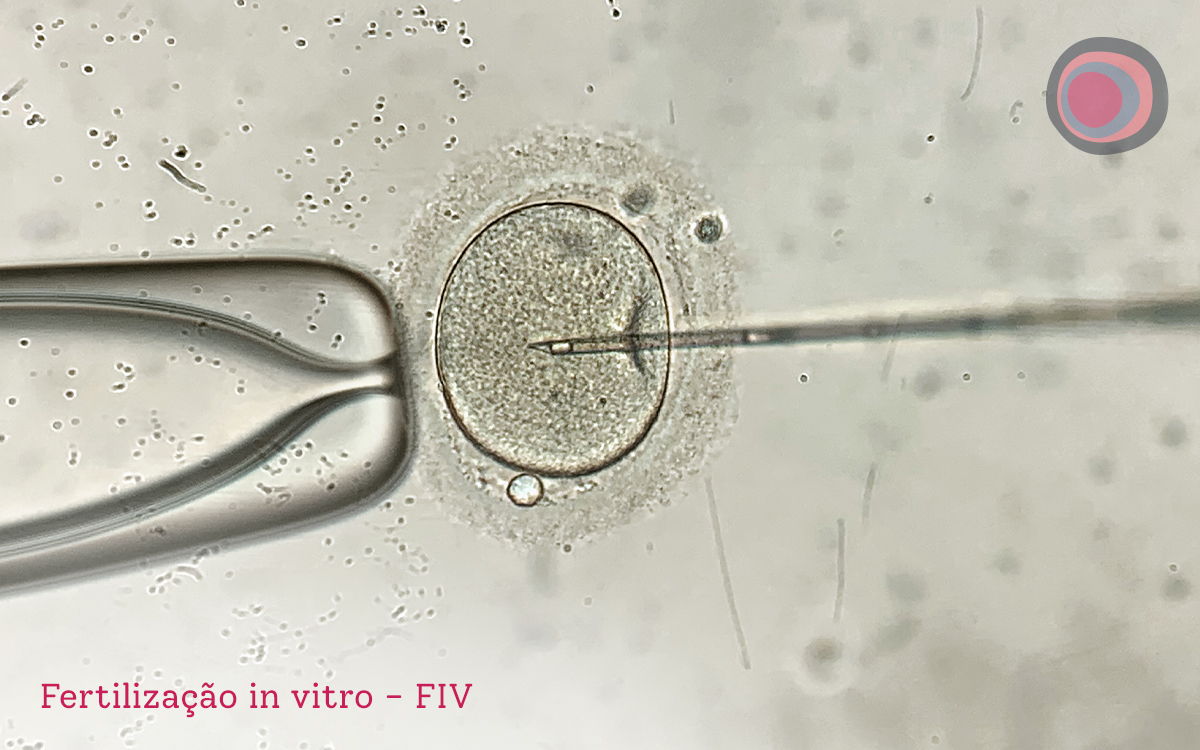 » PGT-A na fertilização in vitro (FIV): o que é e quando é indicado?